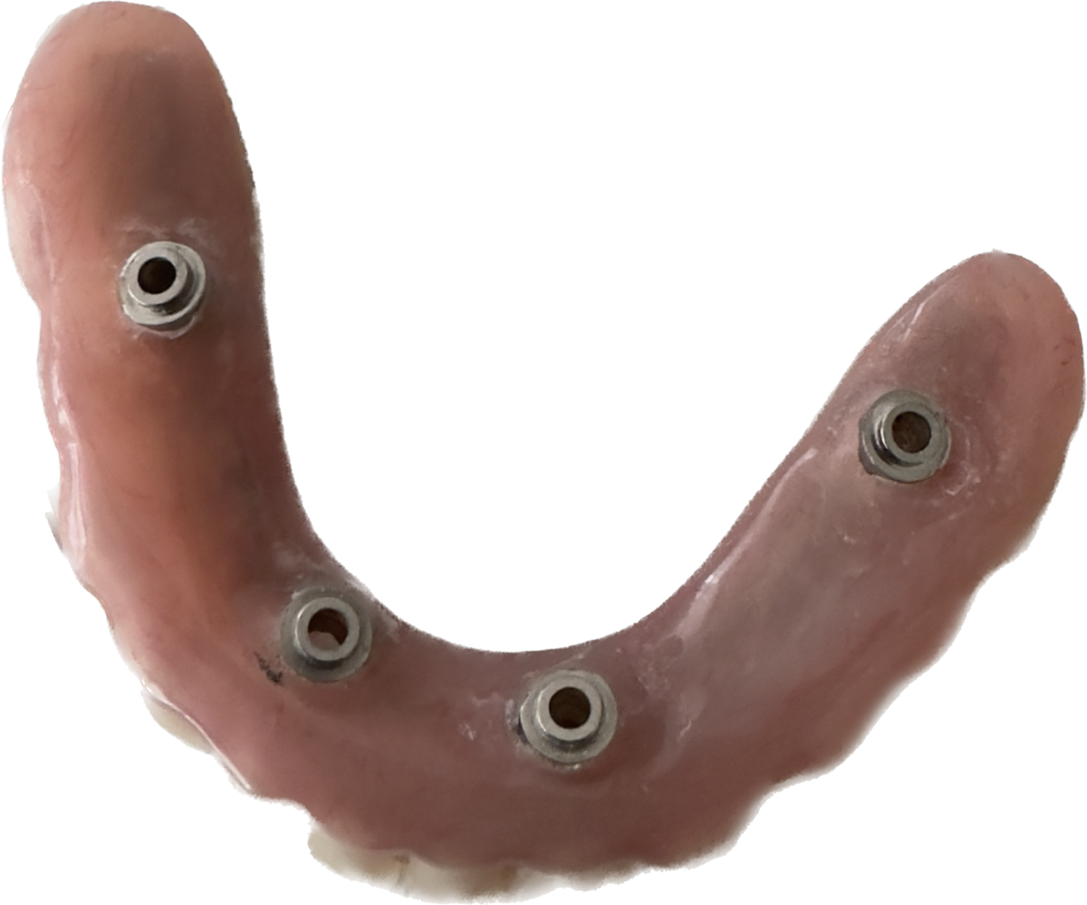 What Are Implant-Supported Dentures? | Best Dentist in North Canton ...